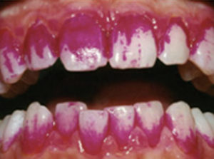 Disclosing Tablets - Smiles by Holsinger & Higgins